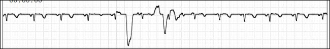 What Is An EKG, and How Does It Work In The New Apple Watch?